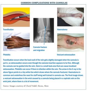 Recognising and reducing the risk of chemotherapy extravasation ...