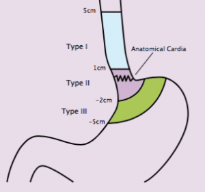 Primary therapy of early oesophageal and gastric cancers | Cancer World ...